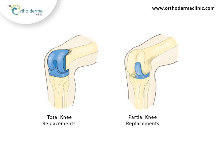 Partial Knee Replacements Archives Orthodermaclinic Partial Knee Replacements Archives Orthodermaclinic