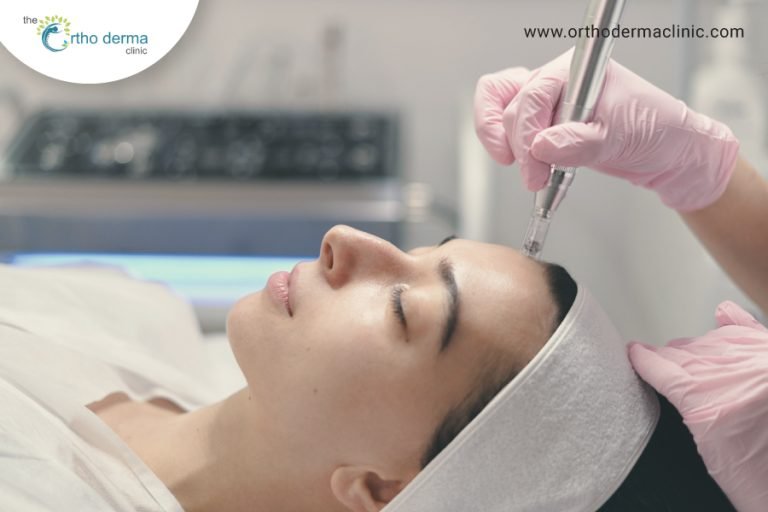 How Does Microneedling Work?